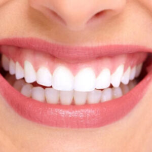 Veneers Specialist Los Angeles | Wilshire Smile Studio